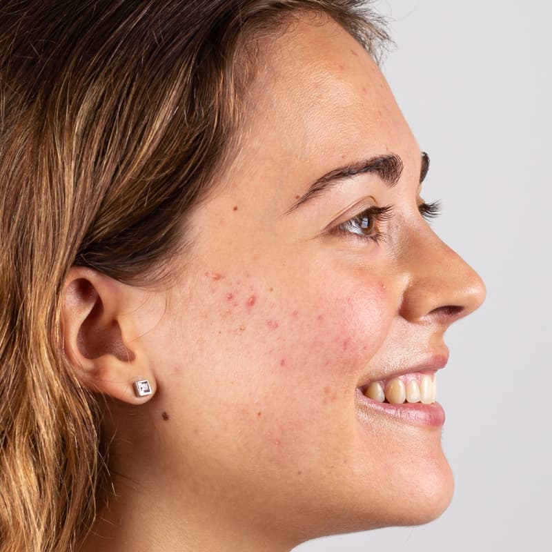 Pack para piel con acné Bye Bye Acne Pack | Freshy Cosmetics